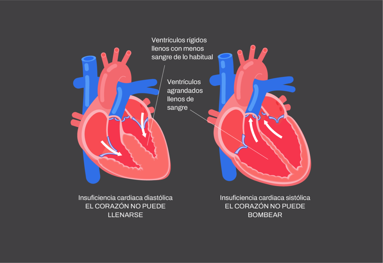 Insuficiencia Cardiaca - Dr. Ricardo García de la Peña