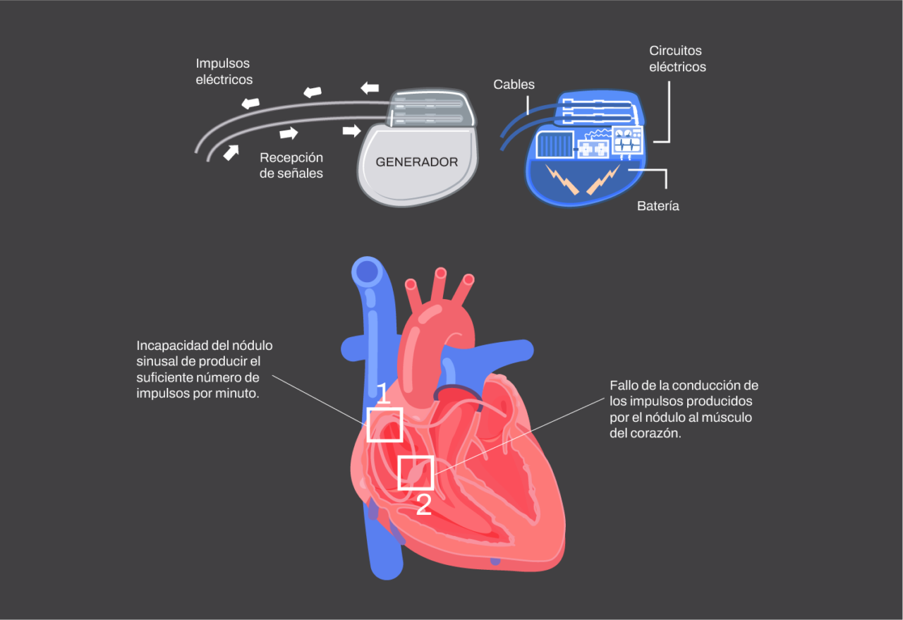 Implante de marcapasos - Dr. Ricardo García de la Peña