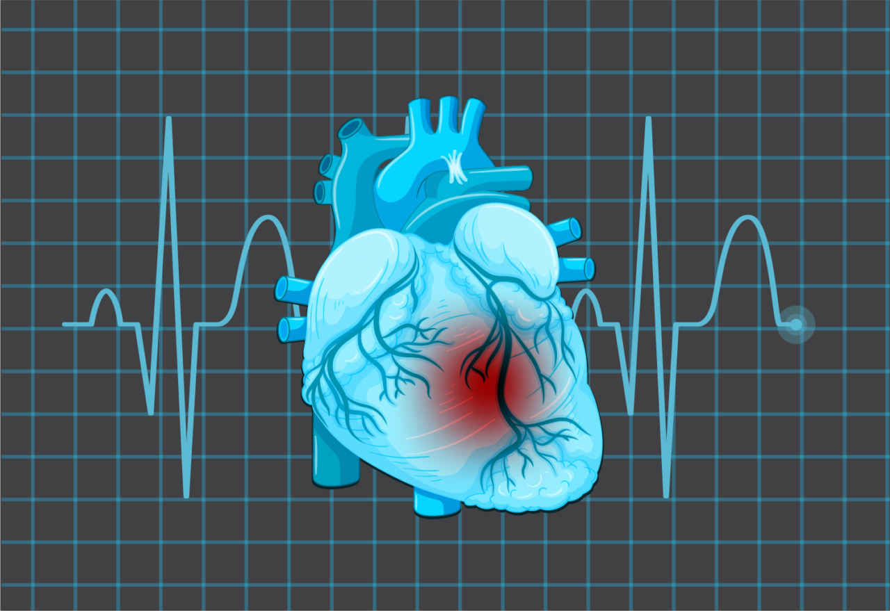 Ataque Cardiaco - Dr. Ricardo García de la Peña