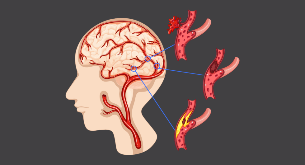 Accidente Cerebrovascular - Dr. Ricardo García de la Peña
